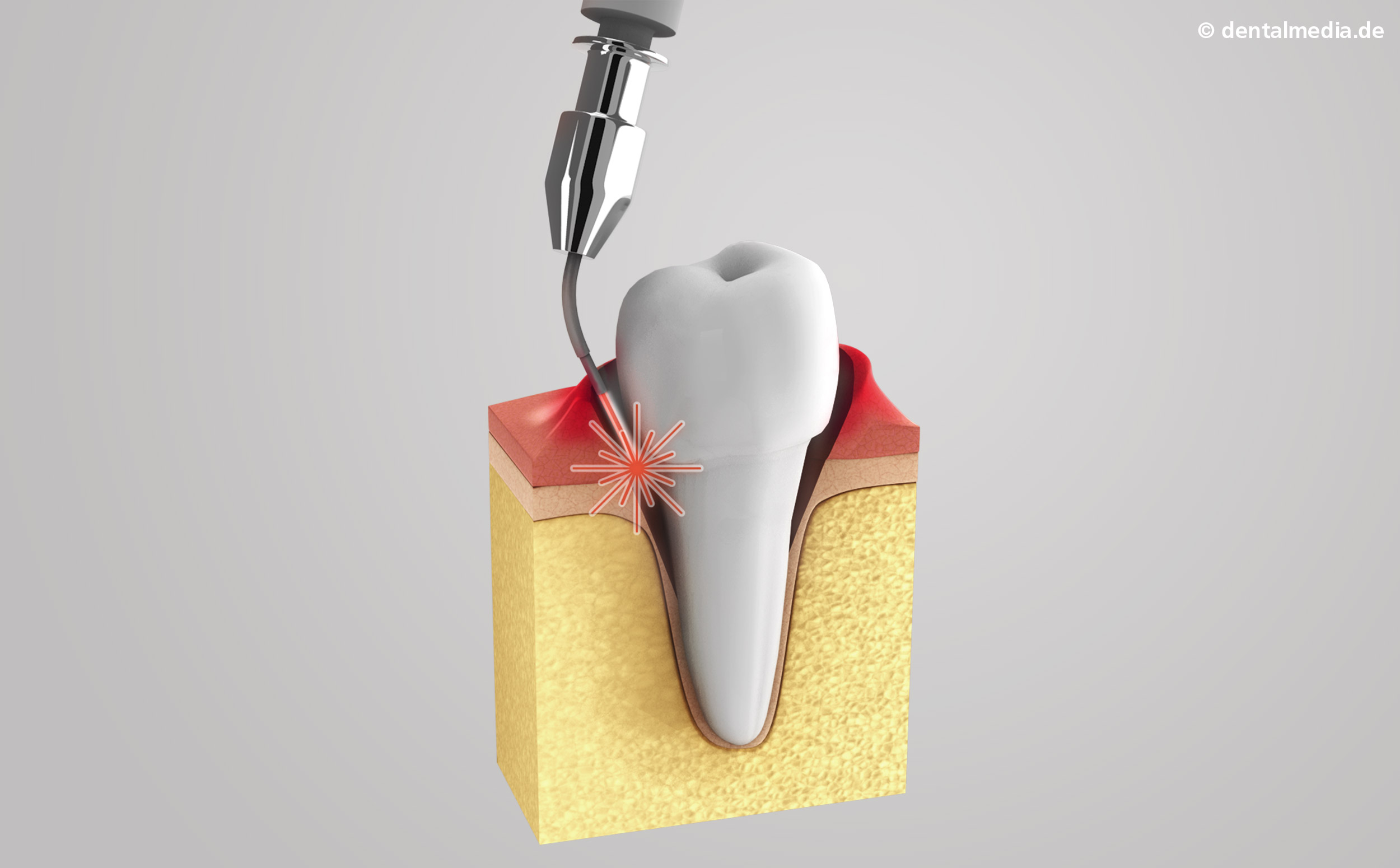 Laser - Zahnarzt Zolk - Blaufelden